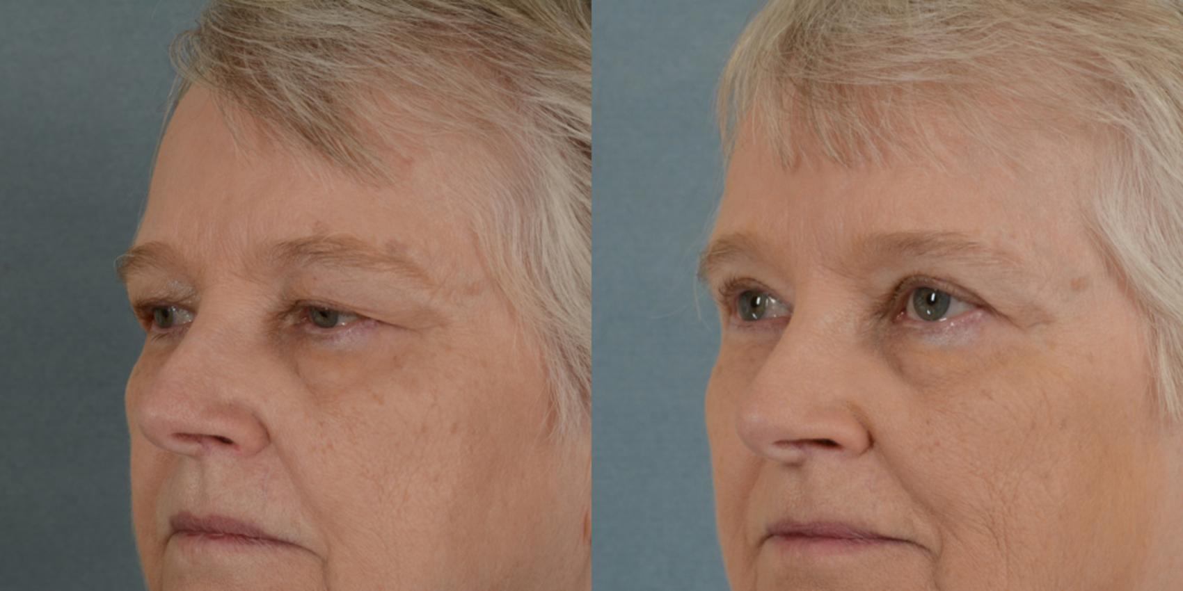 Eyelid Surgery (Blepharoplasty) Before and After Pictures Case 21 ...