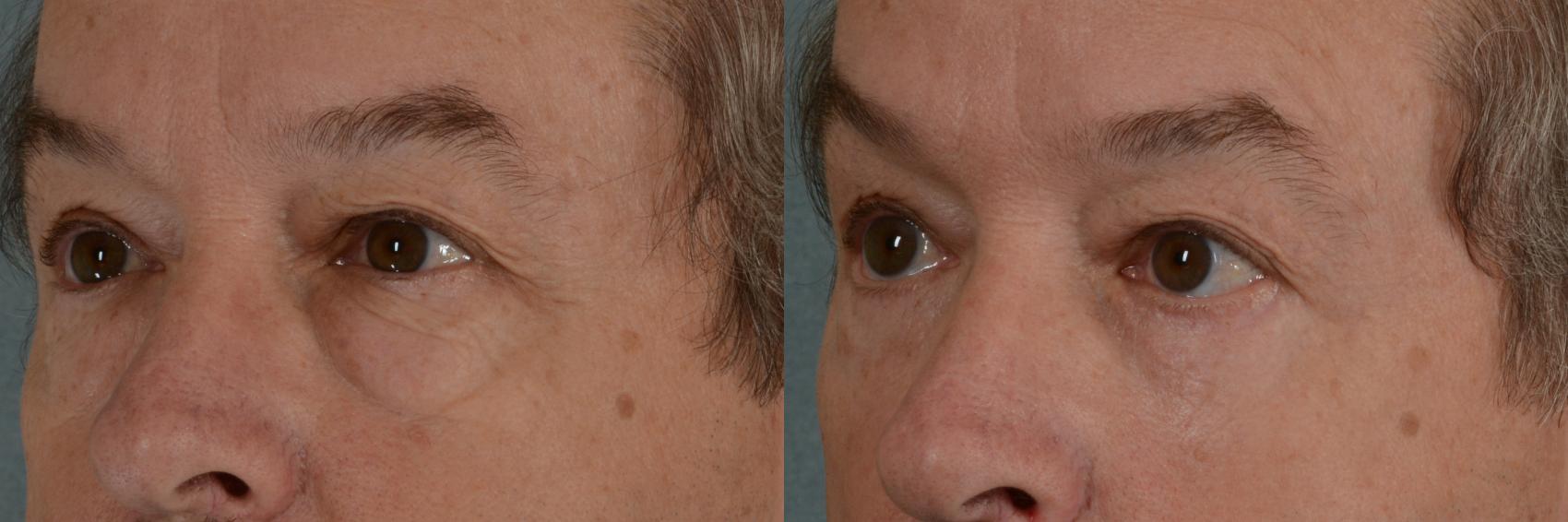 Eyelid Surgery (Blepharoplasty) Before and After Pictures Case 320 ...