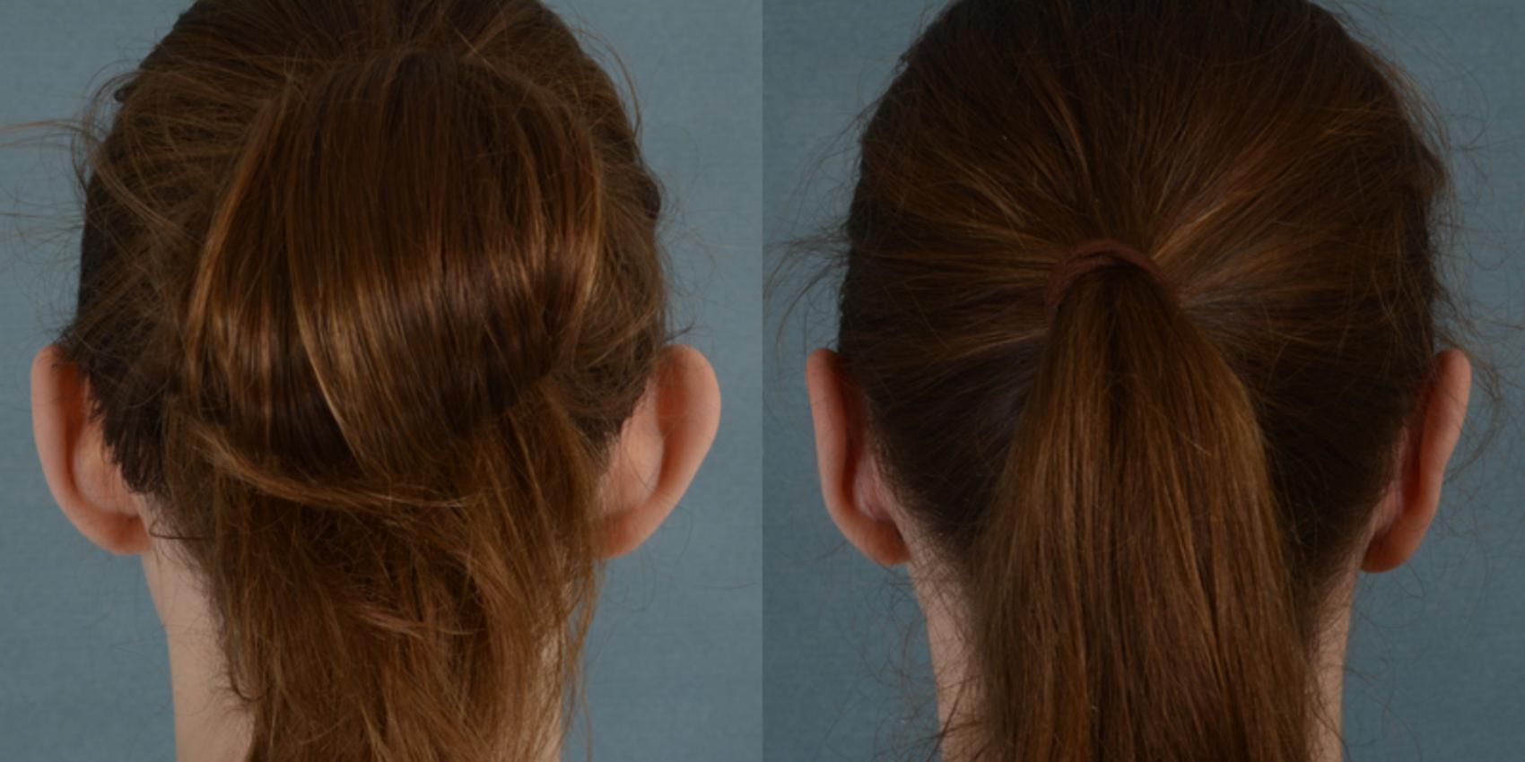 Ear Surgery (Otoplasty) Before and After Pictures Case 74 | Tallahassee ...